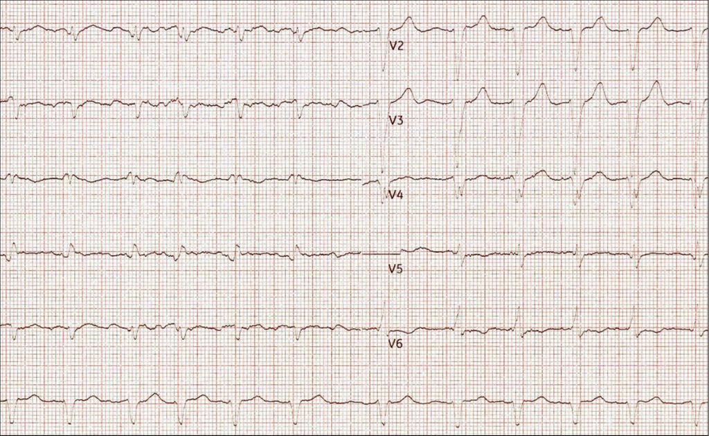Ablationsbehandlung eines Patienten mit atypischem Vorhofflattern ...