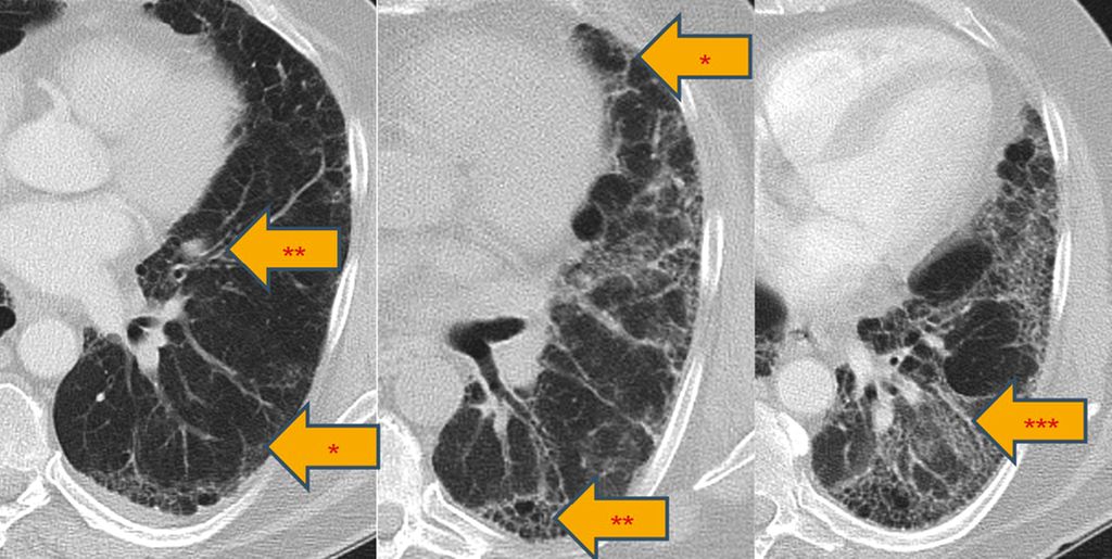 Progredientfibrosierende interstitielle Lungenerkrankungen – Diagnose ...