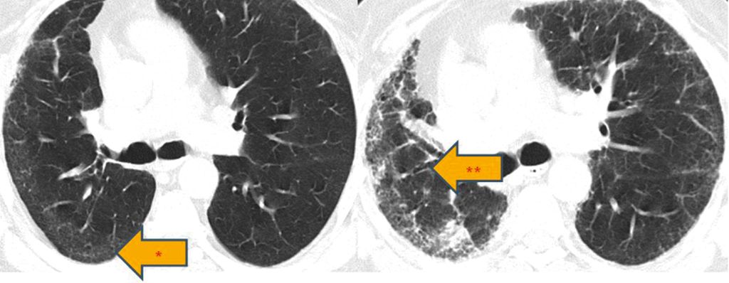 Progredientfibrosierende interstitielle Lungenerkrankungen – Diagnose ...