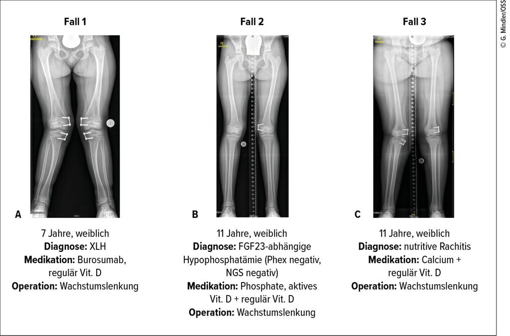 Hypophosphatämie und Deformität: multidisziplinäres Management ...