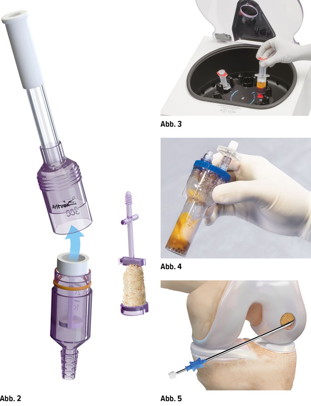 AutoCart™ – einzeitige autologe Knorpeltransplantion - Orthopädie ...