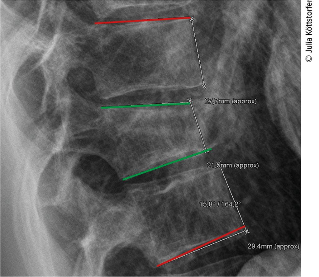 Die Rolle der additiven Kyphoplastie in der Stabilisierung thorakolumb ...