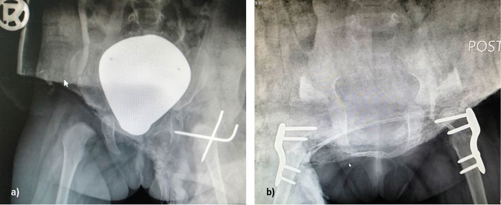 Offene Einrichtung bei Luxation der Säuglingshüfte - Orthopädie ...